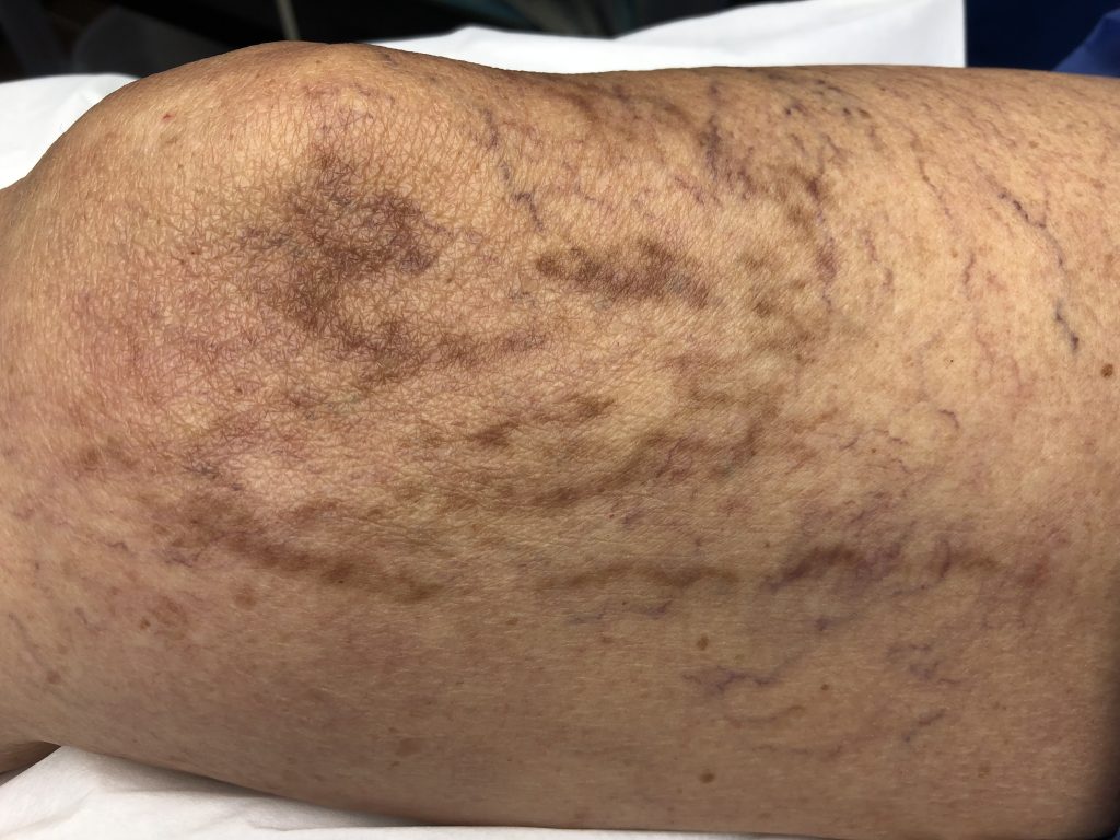 THE TYPES OF STAINING THAT MAY OCCUR AFTER SCLEROTHERAPY | Vein Therapy ...